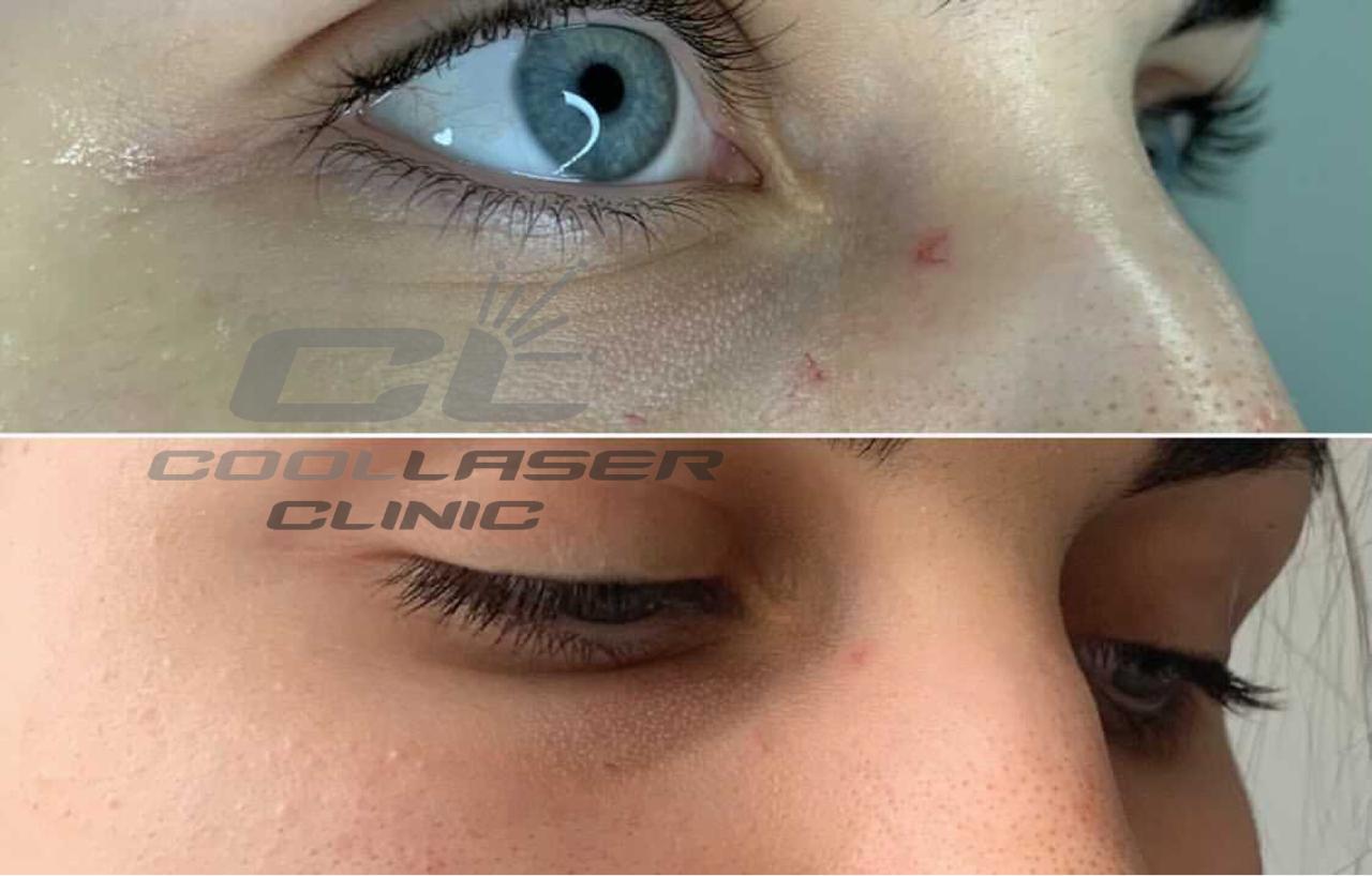 Treatment of rosacea, couperose, telangiectasia and spider veins ...