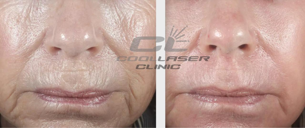 Fractional rejuvenation - Coolaser Clinic