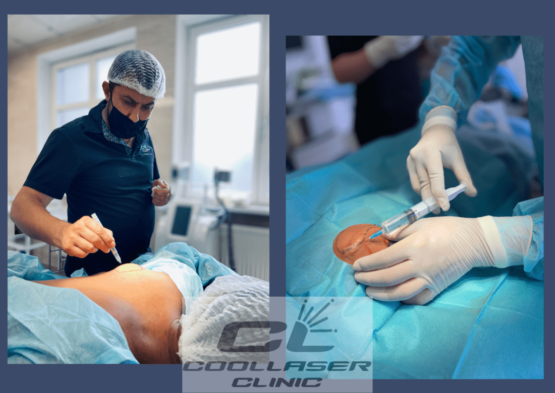 Removal of atheroma, lipoma - Coolaser Clinic